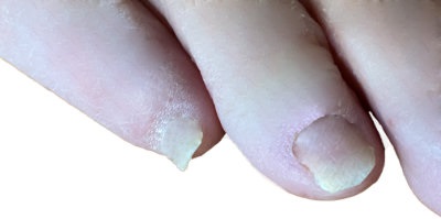 Weird Pinky Toenails - Feminine Feet